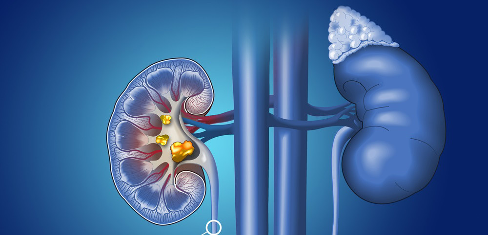 Böbrek taşını doğal yollardan düşürmenin 5 yöntemi